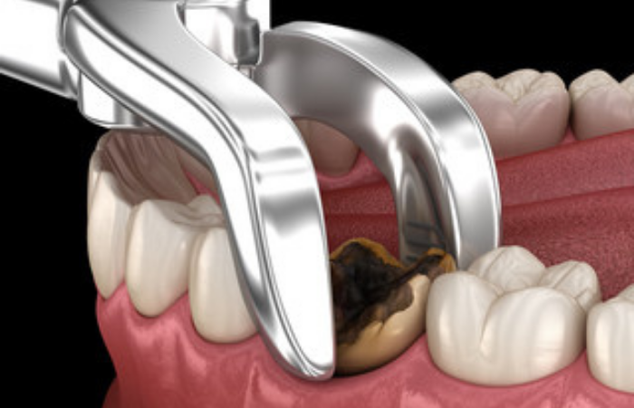 70Dental | Extracción Dental - Sententa Clínica Dental